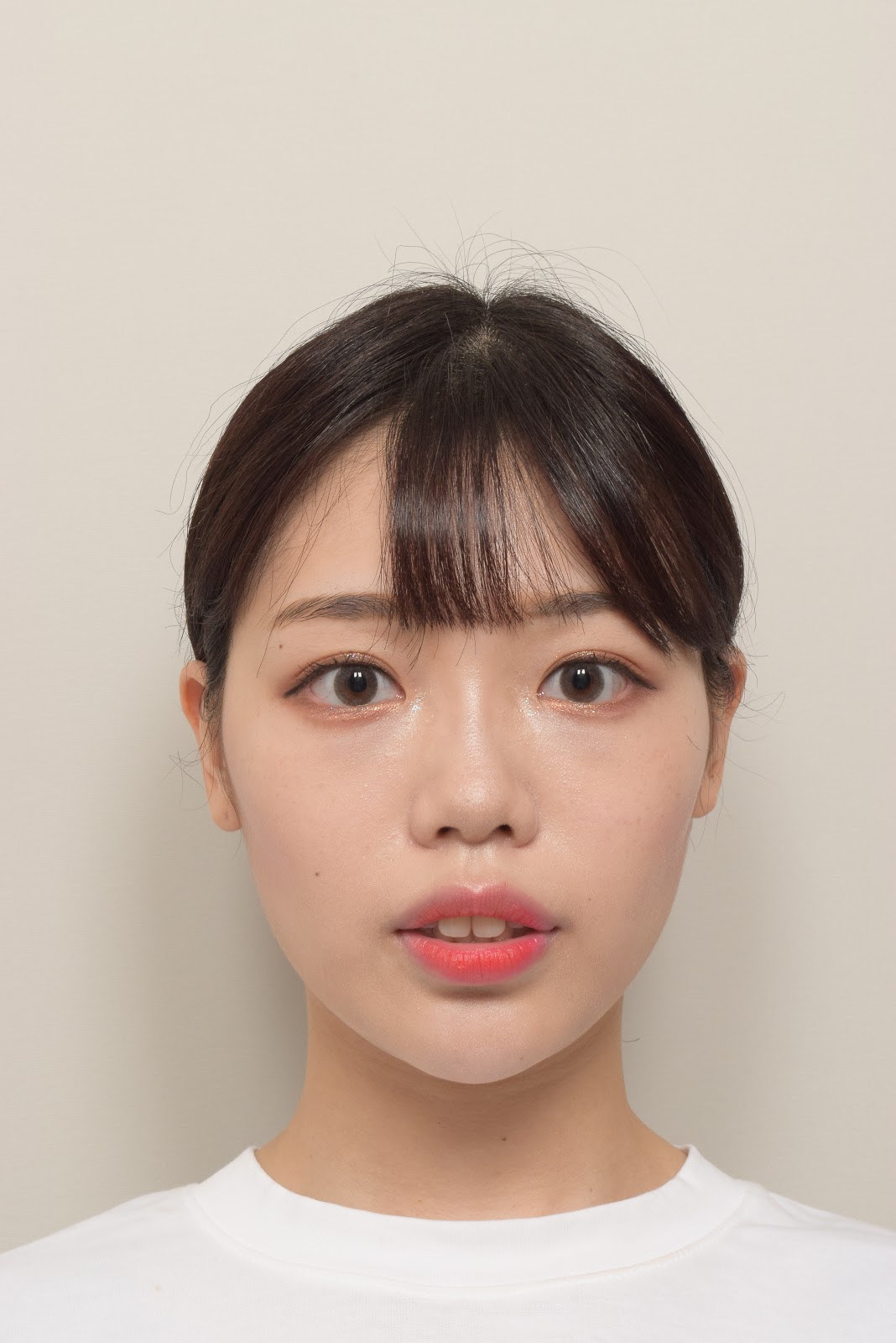 Anterior Segmental Osteotomy (ASO) Surgery _ EU