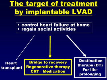 Left Ventricular Assist Device (LVAD)
