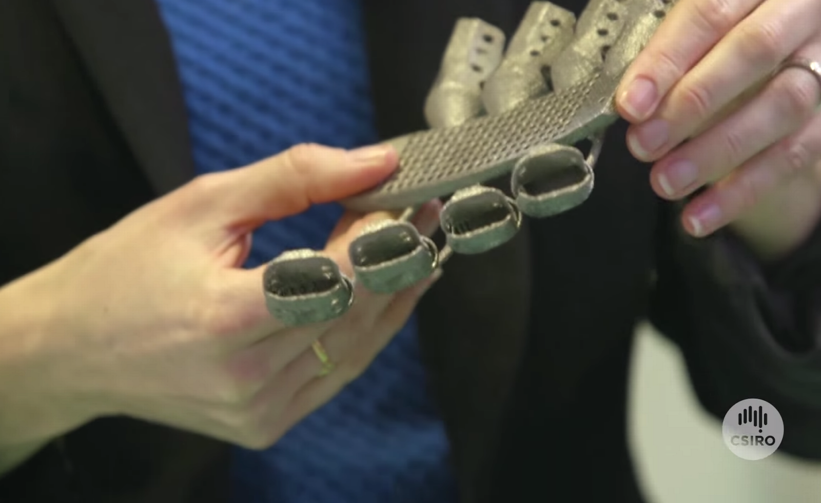 Cancer patient receives world's first 3D printed rib cage in new ...