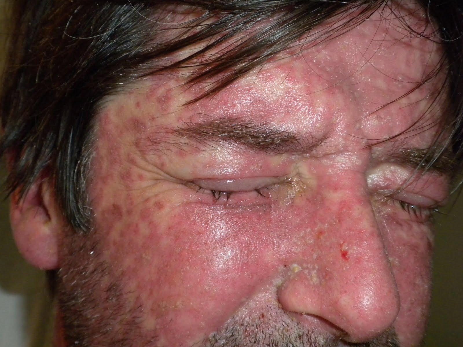 El síndrome de Stevens - Johnson