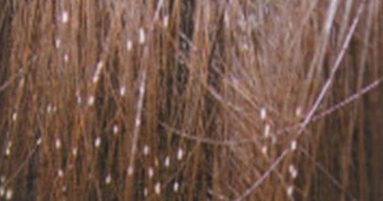 Micosis Humana: Tipos de Dermatomicosis