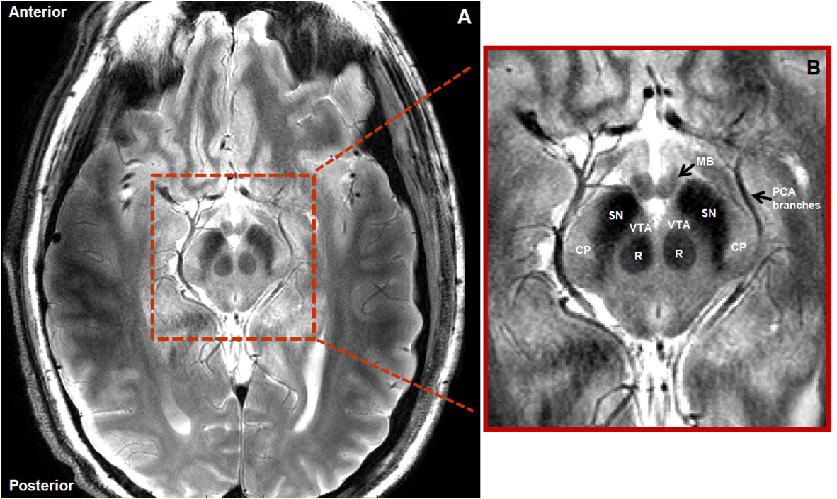 NeuroAnatomía Dr. William Ganem: Parálisis Supranuclear Progresiva ...