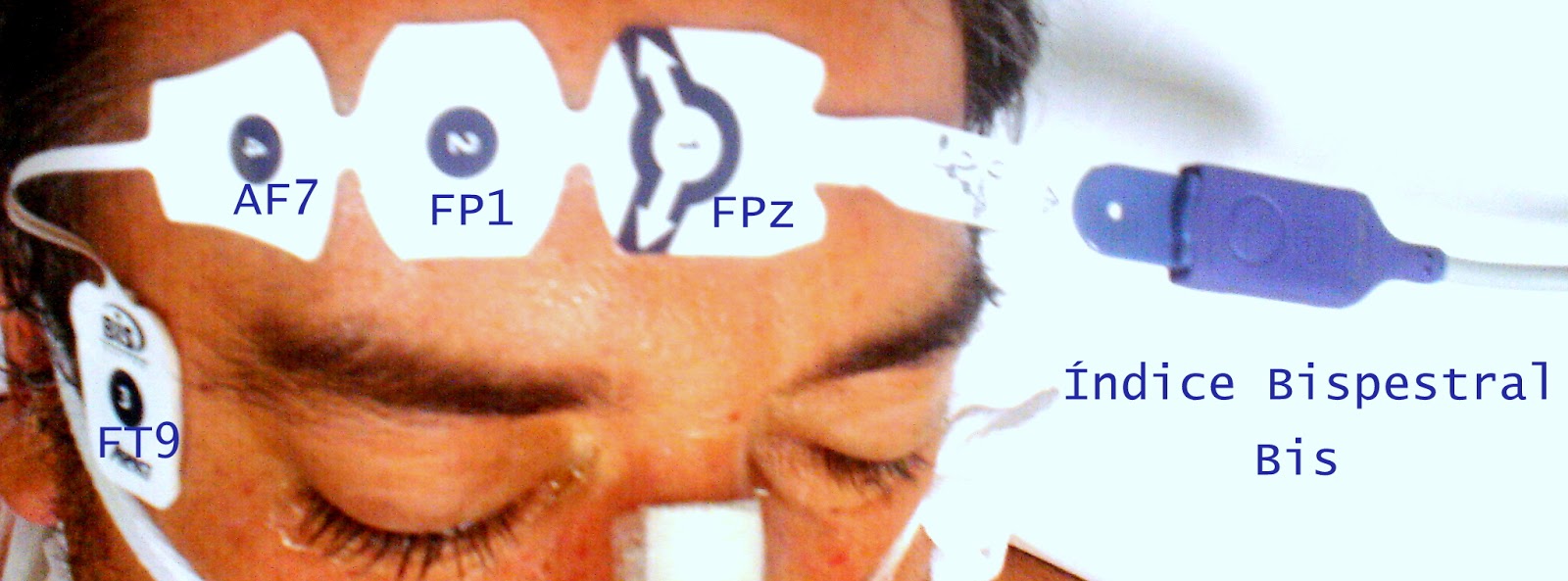 FORMATUAL: MONITORIZAÇÃO DO ÍNDICE BIS (BIS)