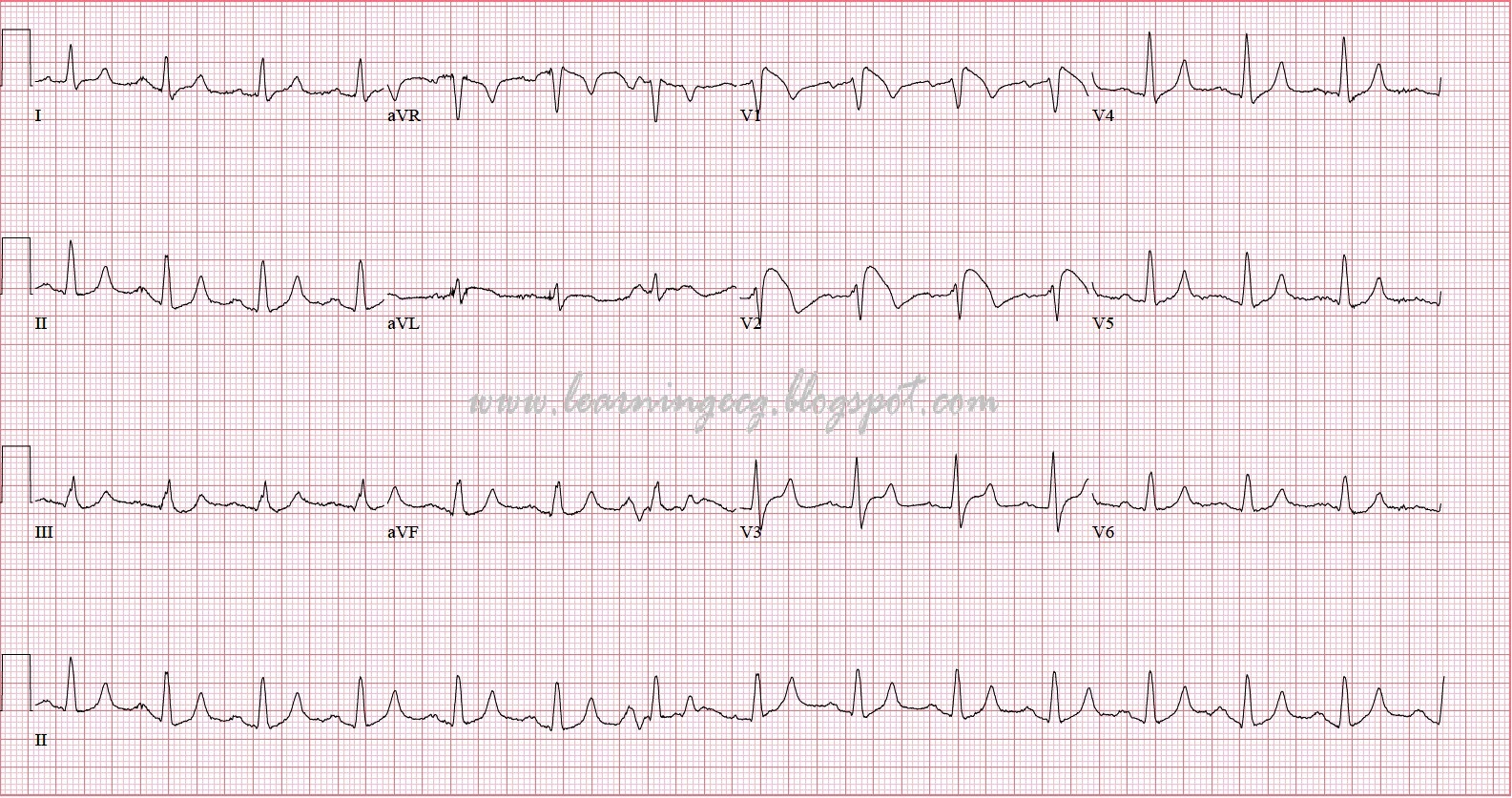 ECG Rhythms: Brugada Phenocopy