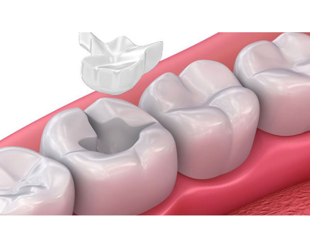 ¿Por qué puede fracasar una restauración con resina dental? - OdontoVida