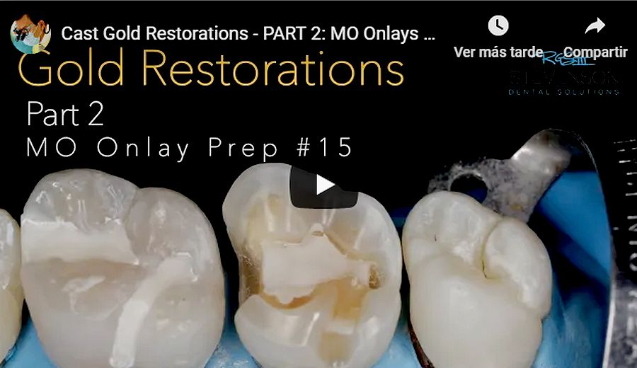CAST GOLD Restorations - PART 2: MO Onlays Prep #15 - Dr. Richard Stevenson