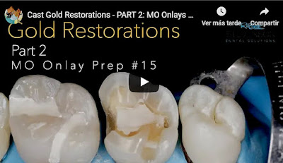 CAST GOLD Restorations - PART 2: MO Onlays Prep #15 - Dr. Richard Stevenson