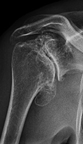 UW Shoulder and Elbow Academy: 44 year old with severe humeral head ...