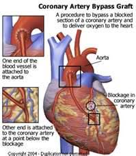 EL "BYPASS" VS. EL "STENT"... | CLICK-OK
