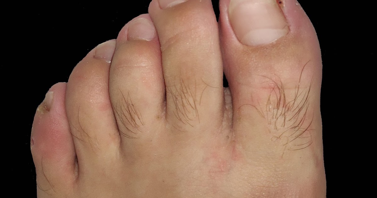 Dermapixel: Onicocriptosis: cuando la uña te toma cariño