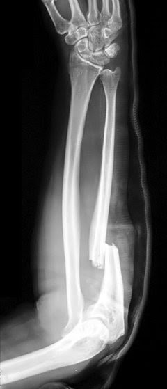 Forearm Fracture Treatment Forearm Bone Fracture Surgery
