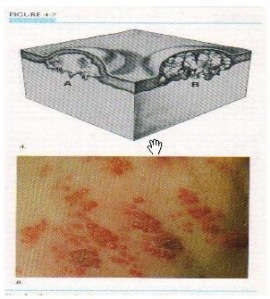 Sari's Time Capsule: UKK (Ujud Kelainan Kulit Primer)