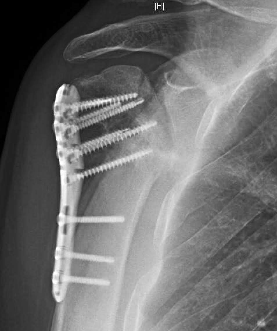 Shoulder Arthritis / Rotator Cuff Tears / Shoulder Pain : Severe post ...