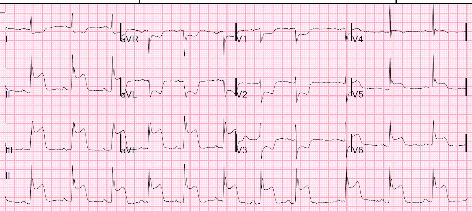Lateral Myocardial Infarction Ecg