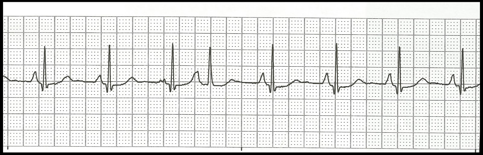 Float Nurse: Basic EKG Rhythm Test 01