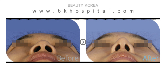 Eyelid Surgery Legend Dr. Kim Byung Gun: [BK Plastic Surgery Hospital ...
