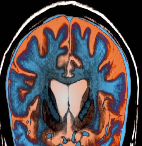 HUNTINGTON'S DISEASE by Esteve Miràngels | MALALTIES GENÈTIQUES
