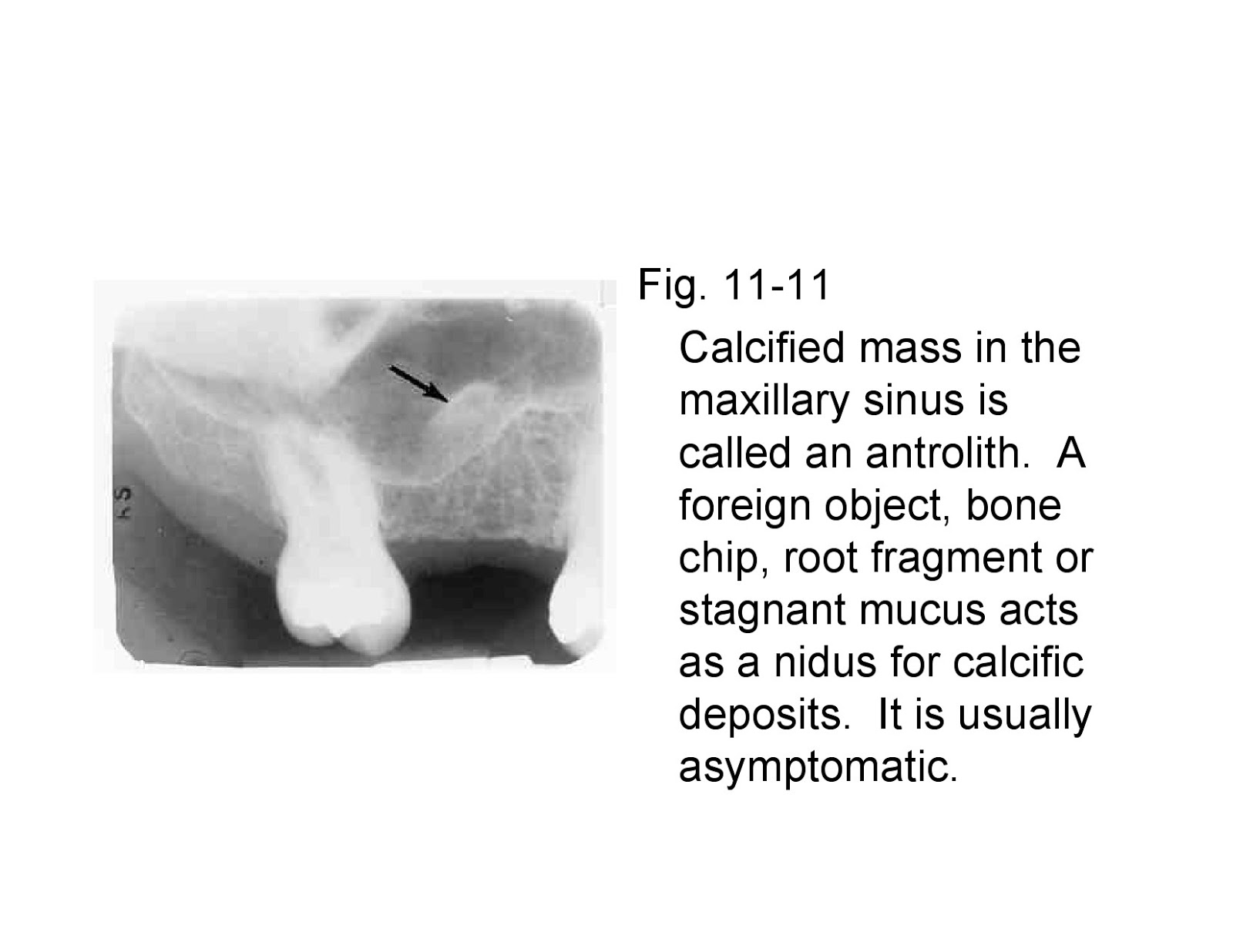 Dentistry and Medicine: SOFT TISSUE CALCIFICATIONS IN ORO-MAXILLO ...