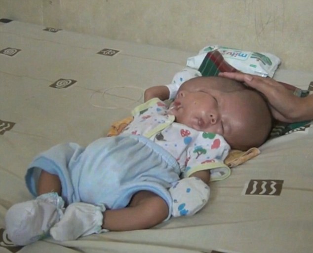 Photos: Baby Born With 2 Faces And Extra Brain from his conjoined twin ...