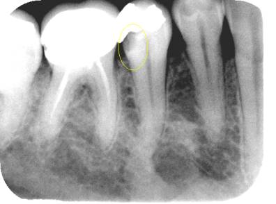 RADIOLOGIA DE LA CARIES DENTAL