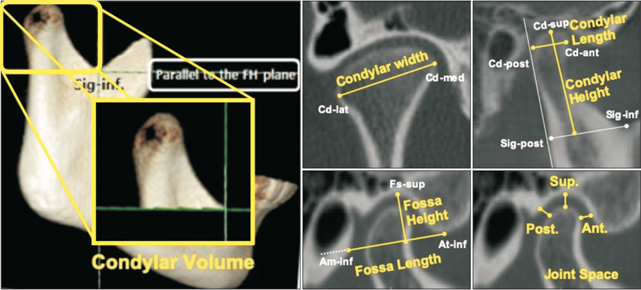 ORTODONTIA CONTEMPORÂNEA: Diferenças na morfologia do côndilo ...