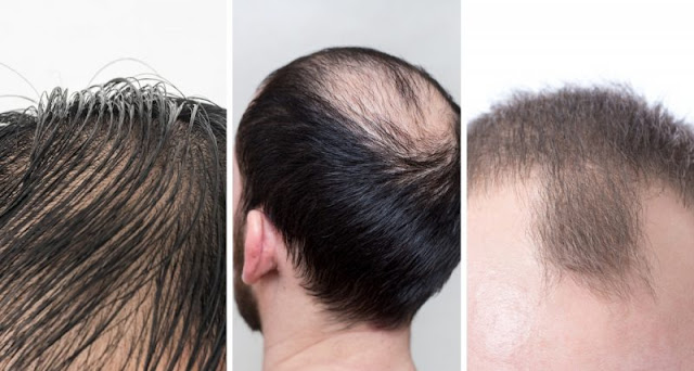 Himalaya Natural Protein 5 Anti-Hair Fall Atasi Masalah Rambut Gugur