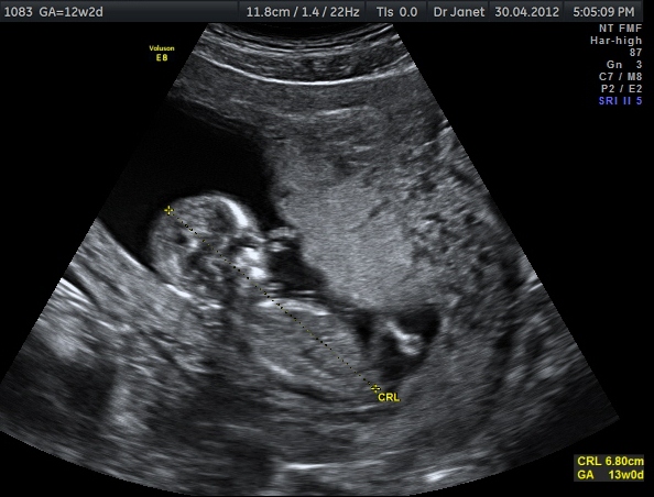 IVF Hope: 12 week NT Scan!! (updated pics)
