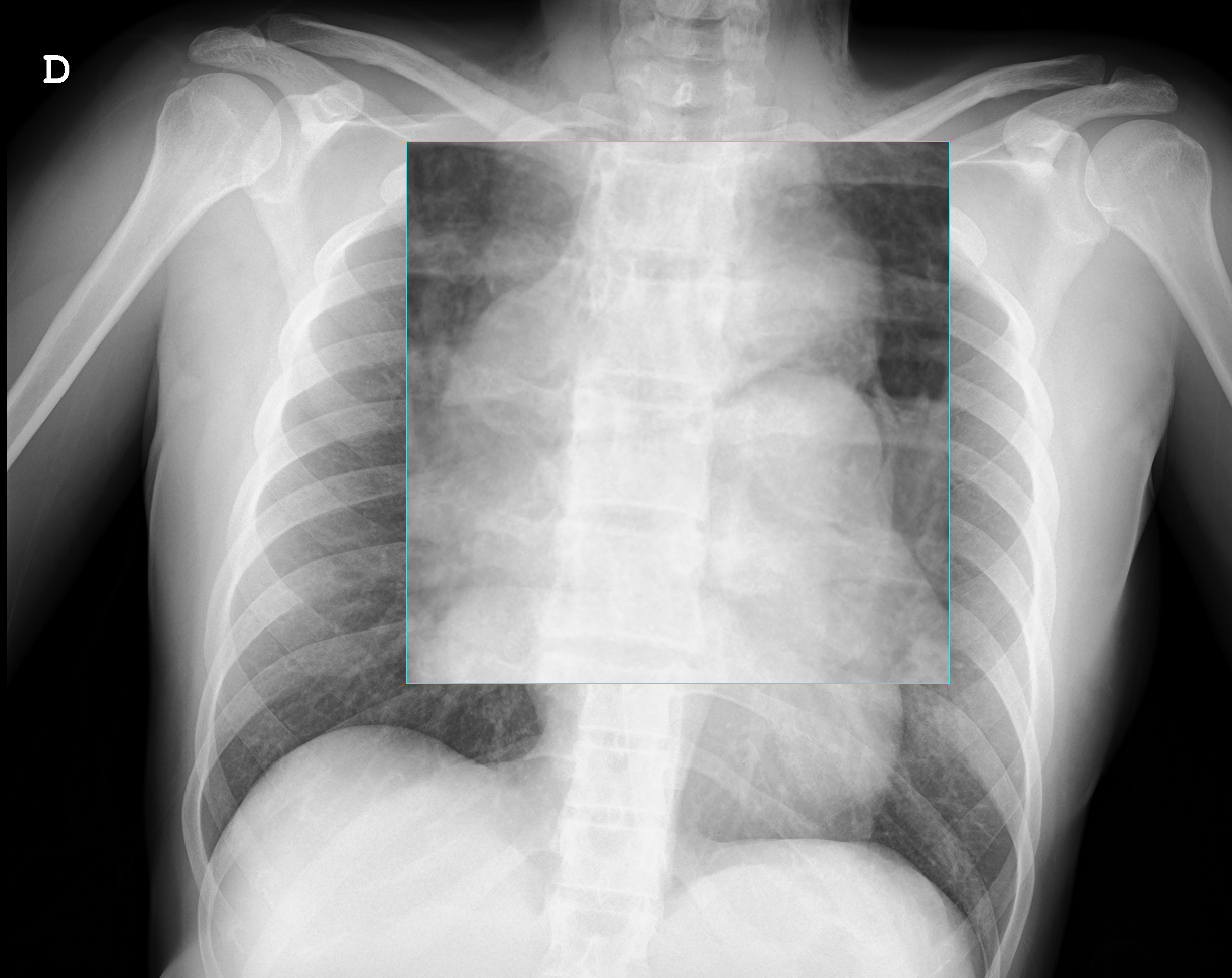 El Blog de Isa y Juan: Signo radiológico del anillo de aire