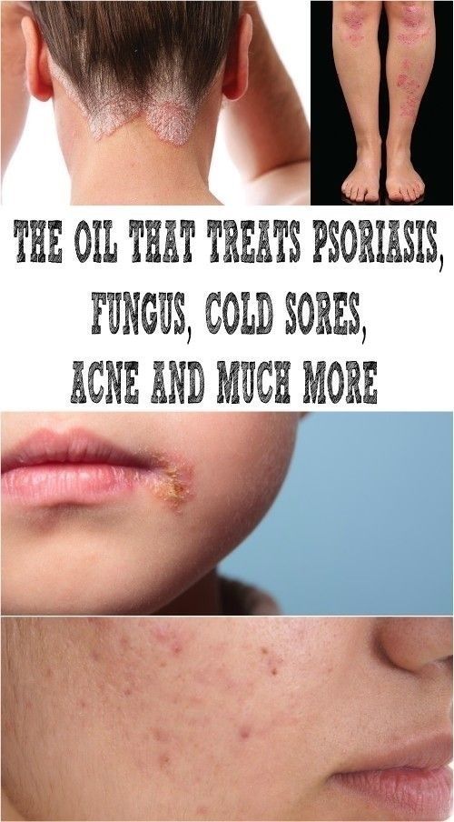 THE OIL THAT TREATS PSORIASIS FUNGUS COLD SORES ACNE AND MUCH MORE ...
