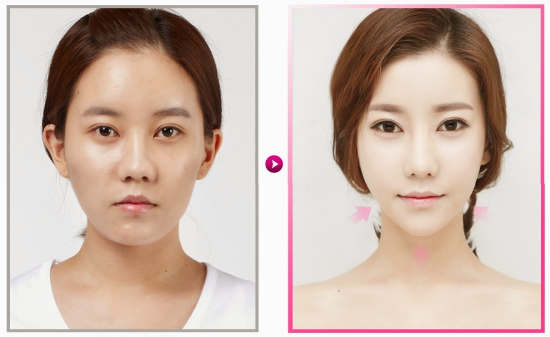 Bệnh Viện Thẩm Mỹ TL Hàn Quốc: [Facial contouring] Two ways to make ...