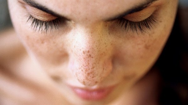 Several Causes of Dark Skin Patches