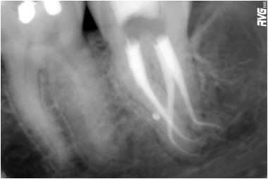 Healthy Ranula: The ProTaper Technique-Shaping the Future of Endodontics