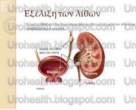 ΛΟΥΤΣΑΡΗΣ ΚΩΝΣΤΑΝΤΙΝΟΣ ΧΕΙΡΟΥΡΓΟΣ ΟΥΡΟΛΟΓΟΣ: ΛΙΘΟΙ ΤΟΥ ΟΥΡΟΠΟΙΗΤΙΚΟΥ