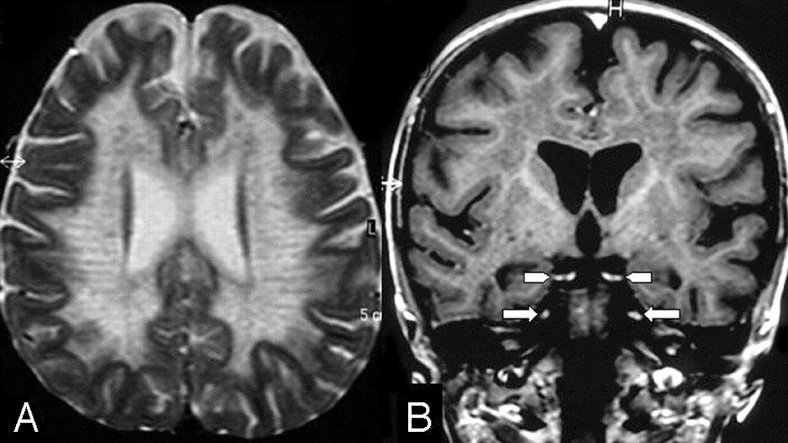 Leucodistrofia Metacromática - Definição, Causas, Sintomas, Diagnóstico ...