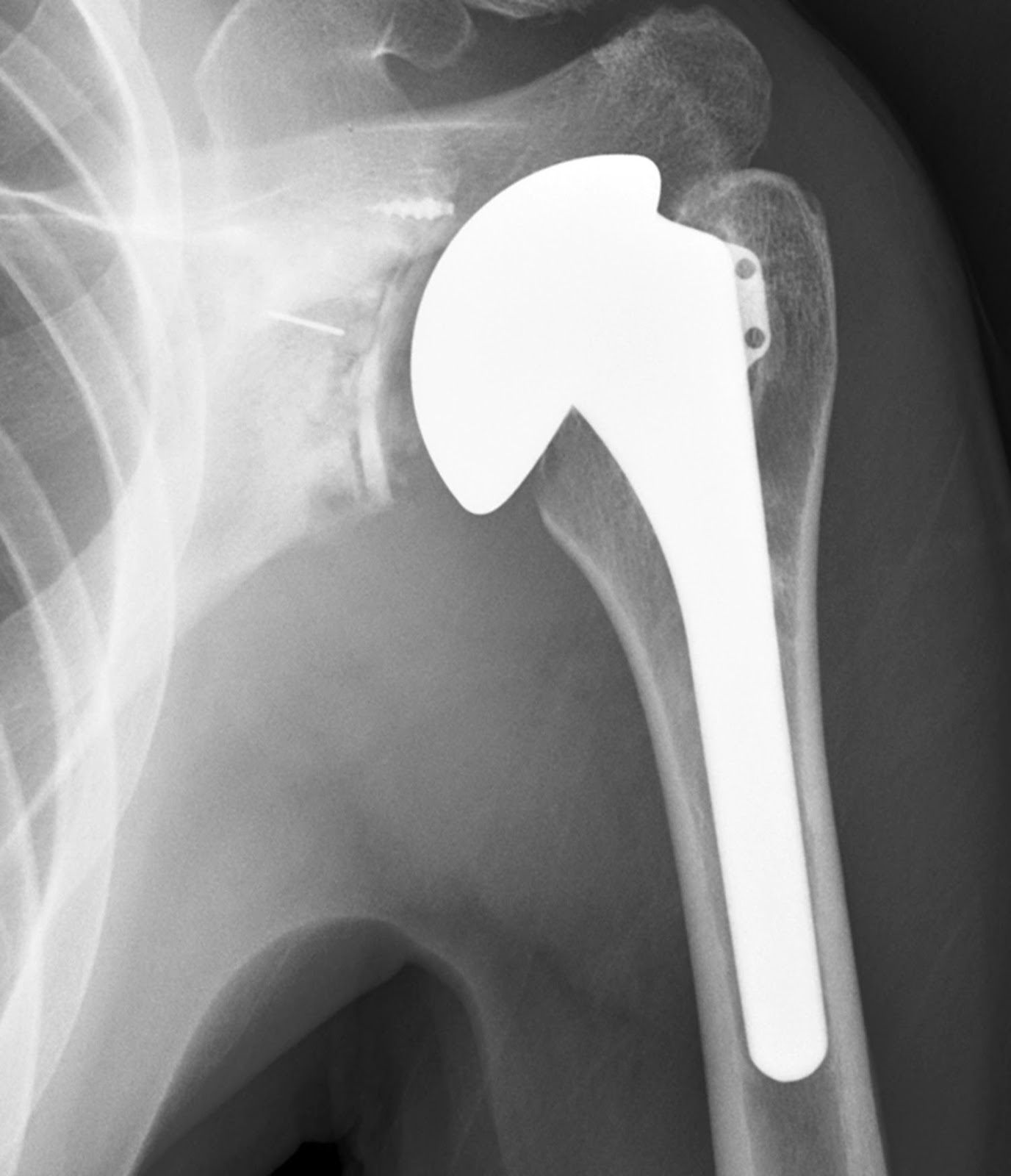 Shoulder Arthritis / Rotator Cuff Tears / Shoulder Pain : Shoulder ...