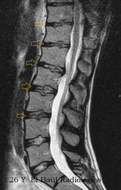 El Baúl Radiológico: ENFERMEDAD DE SCHEUERMANN (DORSALGIA JUVENIL ...