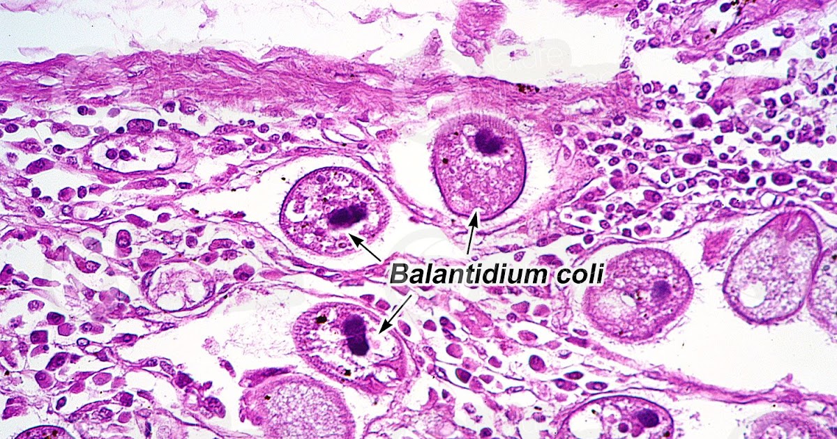 Espacio de la Parasitologia: BALANTIDIASIS