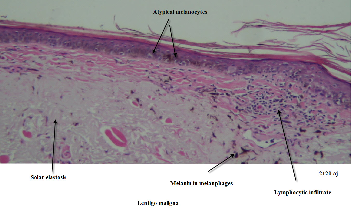 Dermpath Made Simple - Neoplastic: Lentigo Maligna