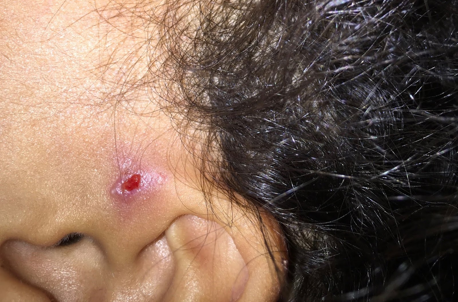 Diverging Lives: Preauricular (Ear) Pit