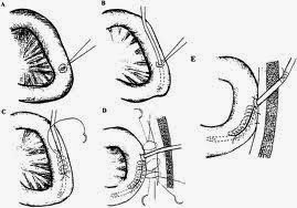 OTMANAGE: SURGICAL PROCEDURE 5 Jejunostomy