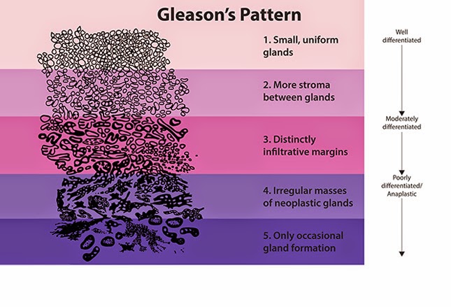 Feel Good Feeling Good: Gleason score - A pathologist's experience and ...