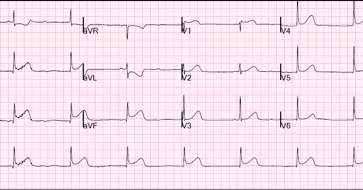 Dr. Smith's ECG Blog: Inferior STEMI with AV Block, Cardiogenic Shock ...