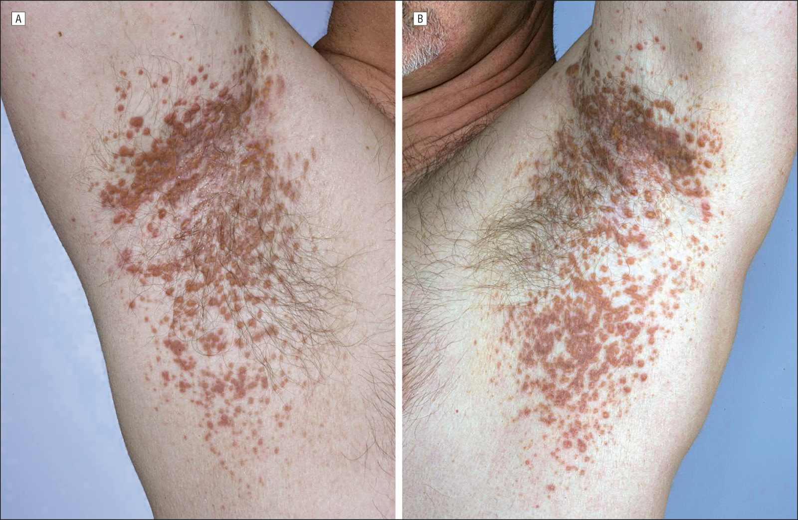 Xanthomas Definition