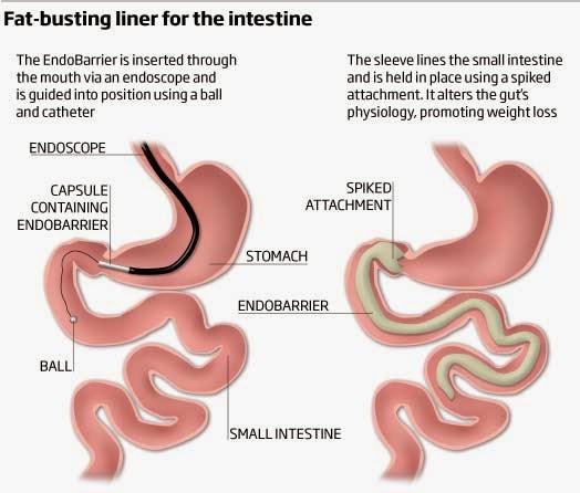 Dr Pok Eng Hong 卜運宏医生 Laparoscopic Surgery Adventure: EndoBarrier ...