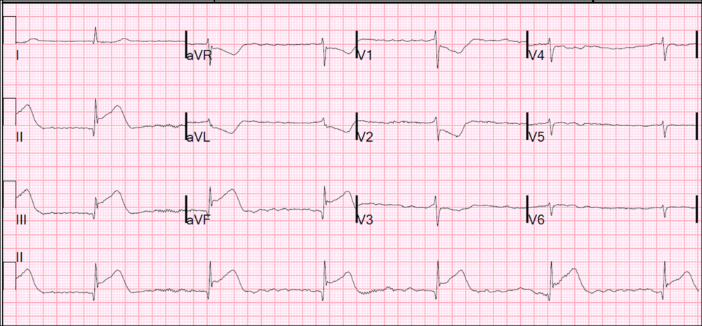 How To Spot Right Ventricular (RV) Infarction on ECG