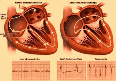 WPW syndrome | MANAGEMENT OF HEART DISEASE
