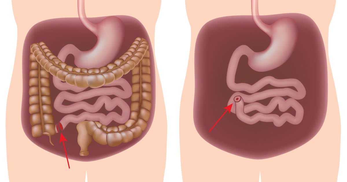 Gastric Health Blog: Different Types Of Colectomy Surgery