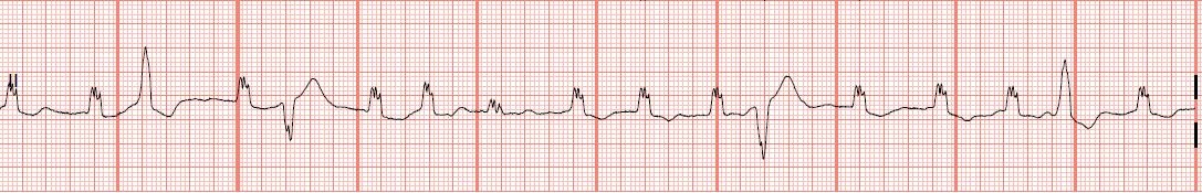 EKG Rhythm Strips 56: Atrial Fibrillation