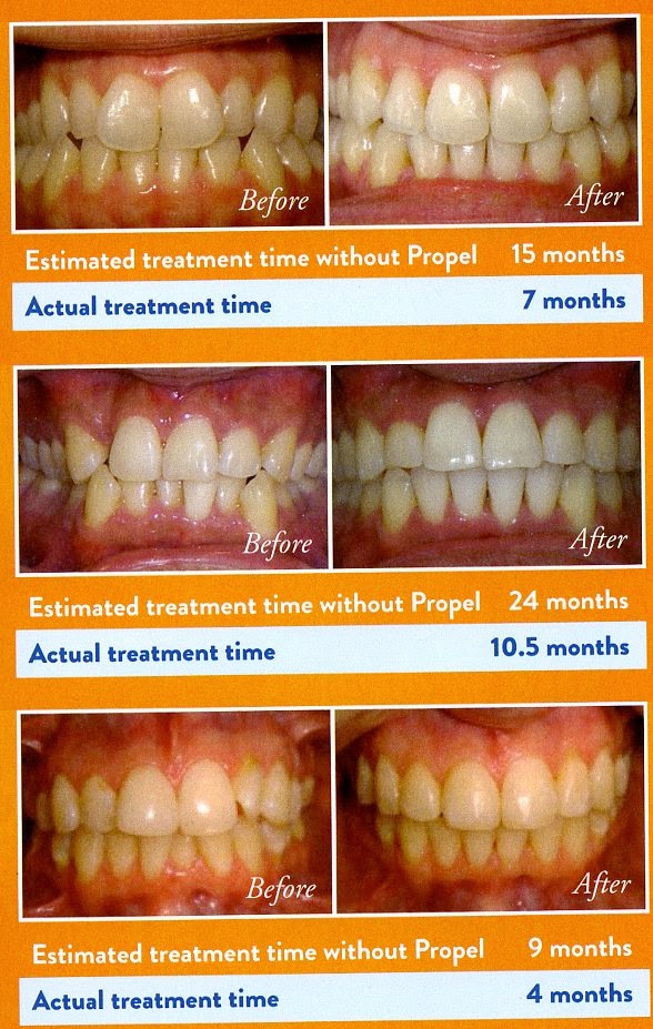 Century Orthodontics: Faster Treatment with Propel Orthodontics