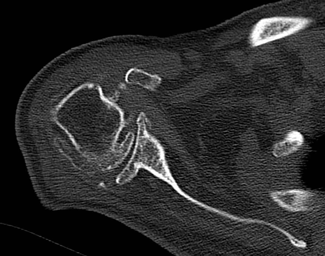 Shoulder and Elbow Surgery: Dislocation of reverse shoulder replacement ...